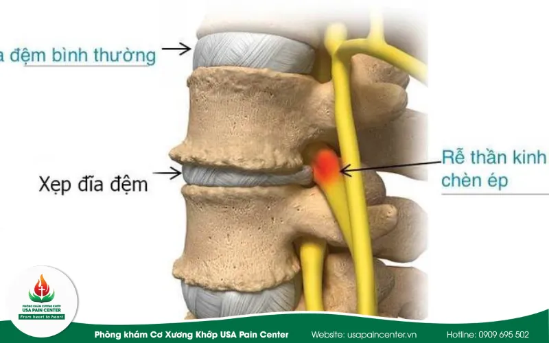 Hiểu thuật ngữ trên phim MRI cột sống để điều trị bệnh kịp thời