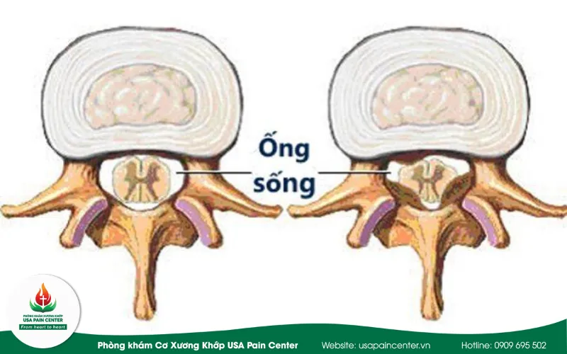 Hiểu thuật ngữ trên phim MRI cột sống để điều trị bệnh kịp thời